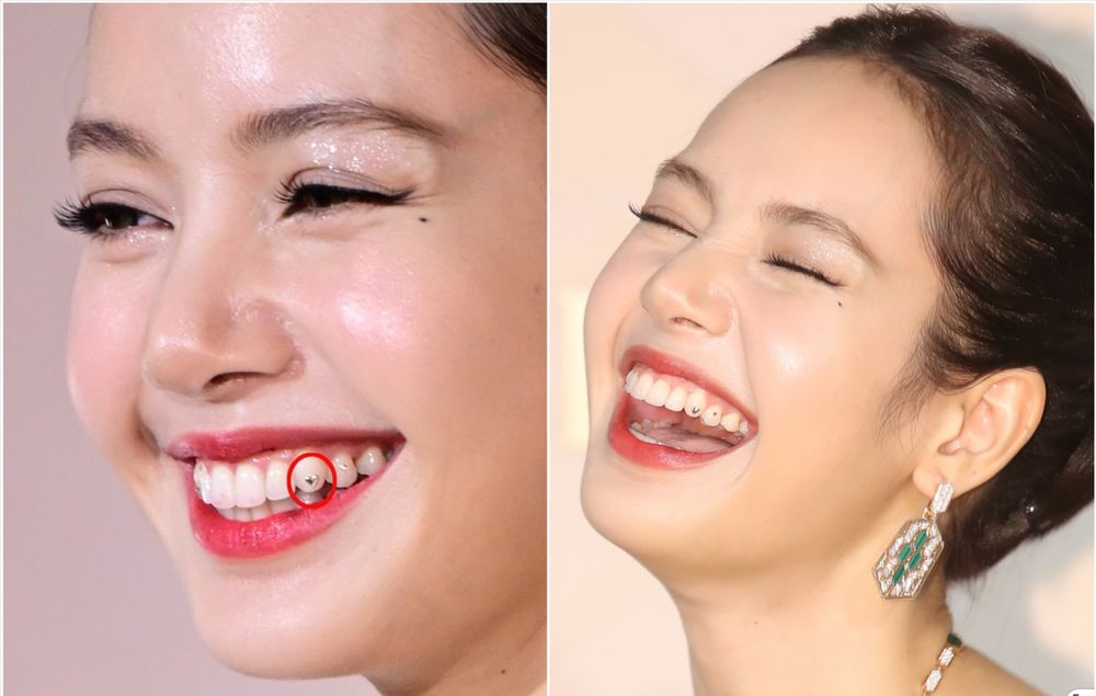 Đính đá răng: Xu hướng thẩm mỹ nha khoa